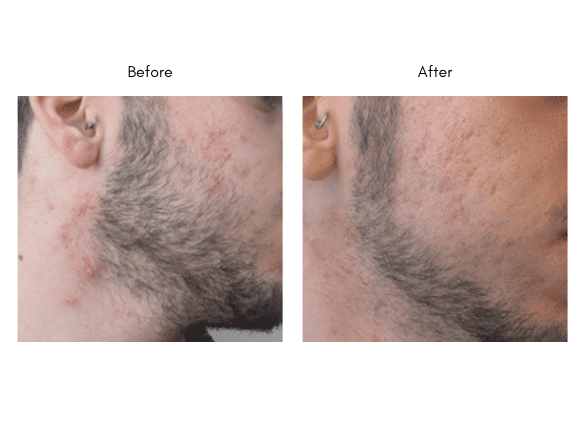 IPL Hair Removal – Pink Parlour